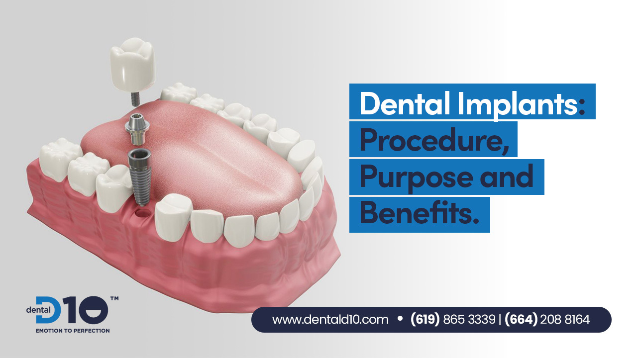 Dental Implants: Procedure, Purpose & Benefits