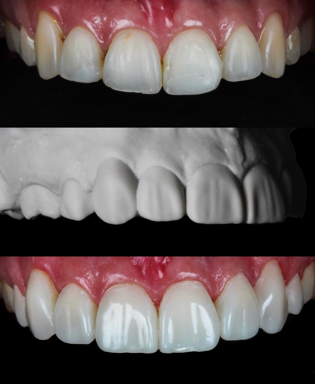 Composite veneers in Tijuana - Dental D10